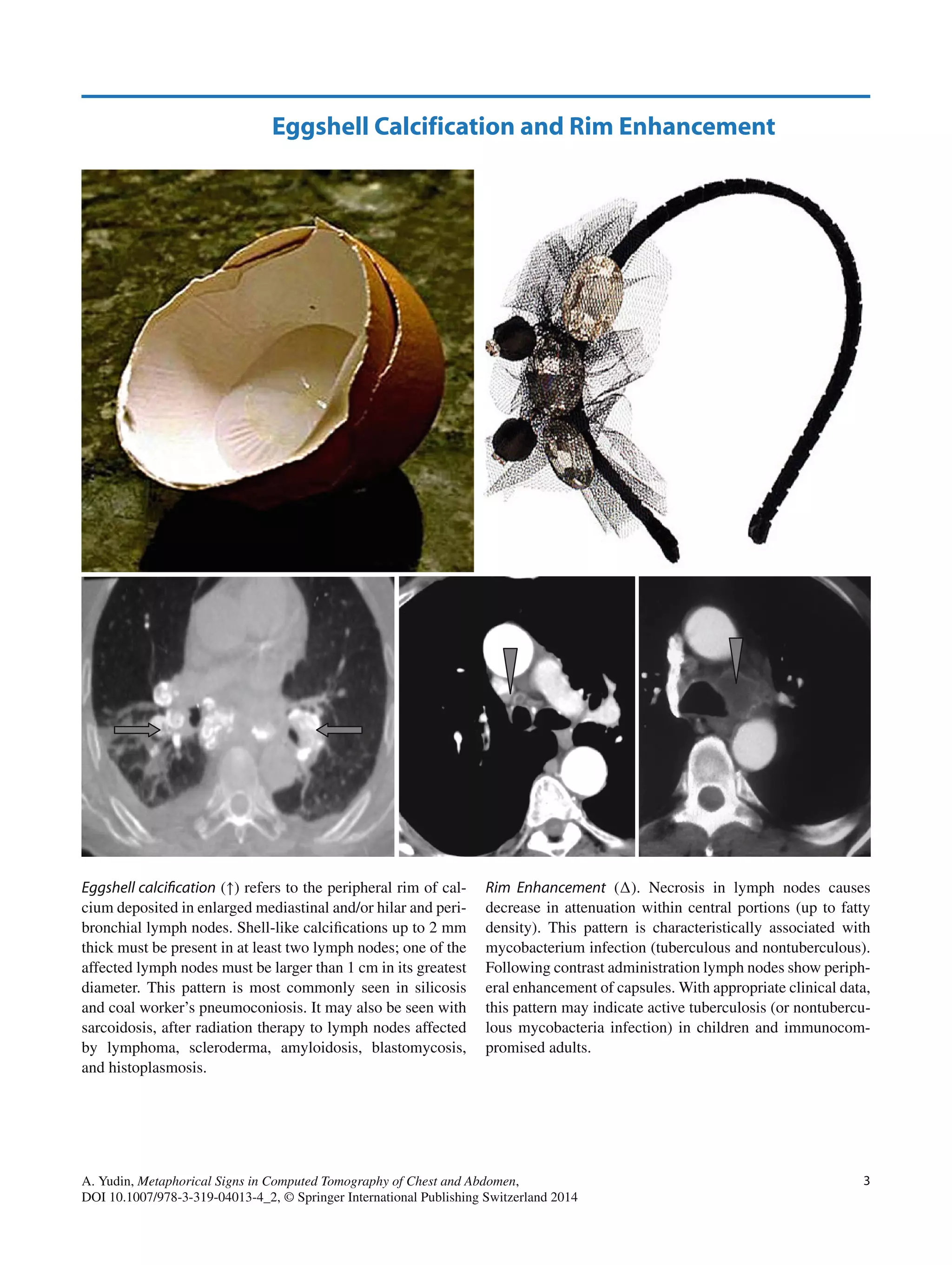 0. metaphorical signs in computed tomography of chest and abdomen | PDF