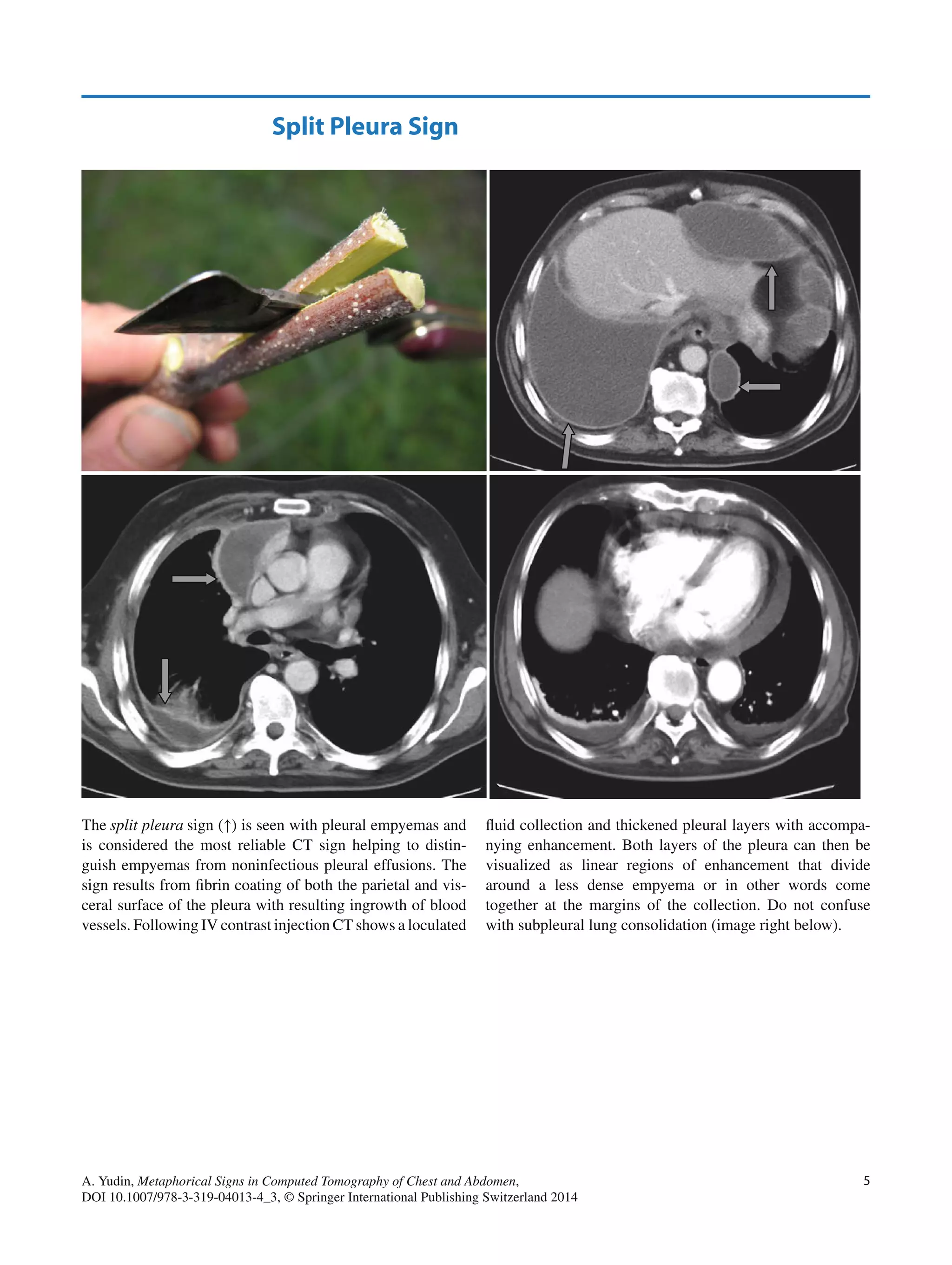 0. metaphorical signs in computed tomography of chest and abdomen | PDF