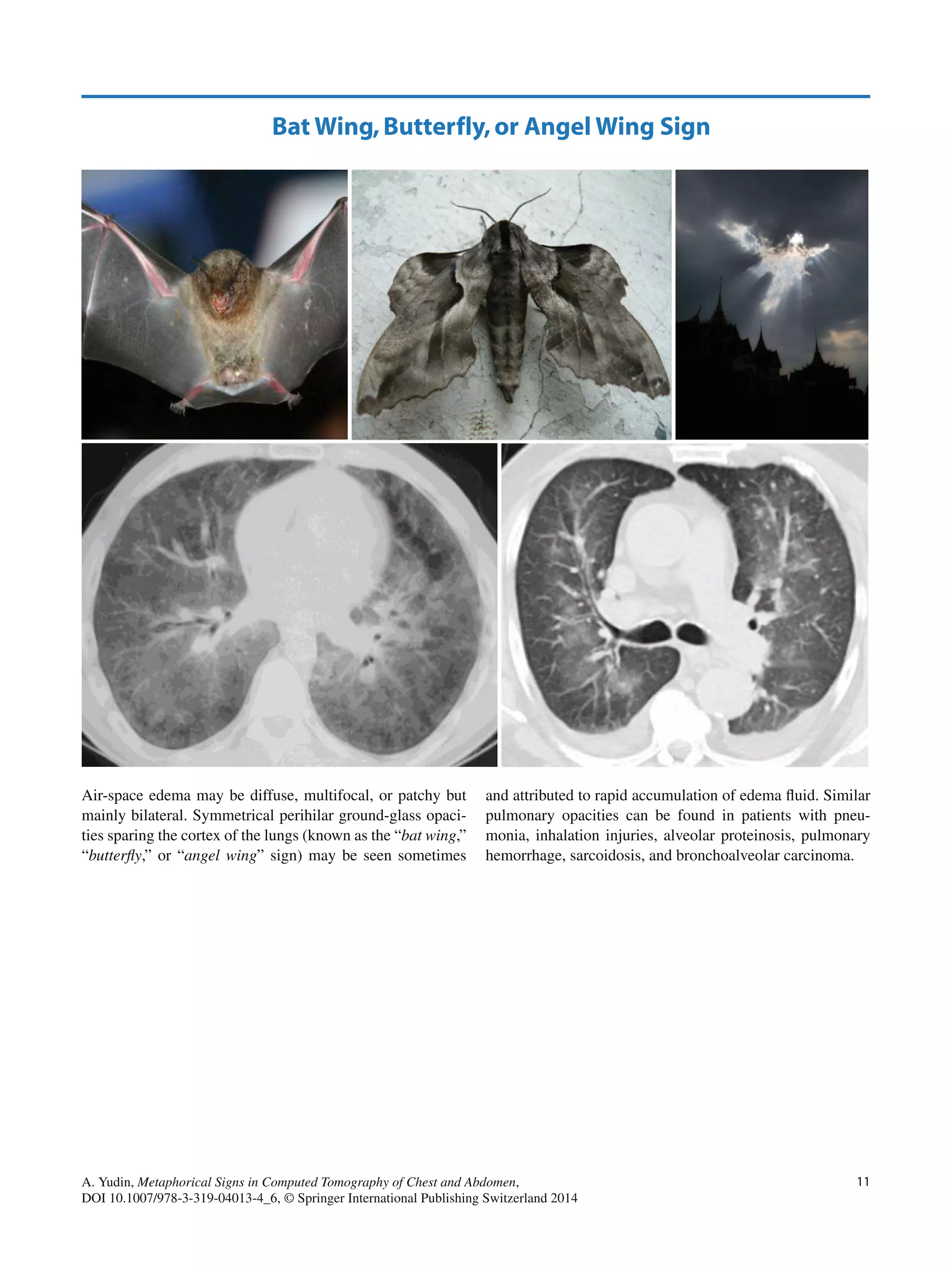 0. metaphorical signs in computed tomography of chest and abdomen | PDF