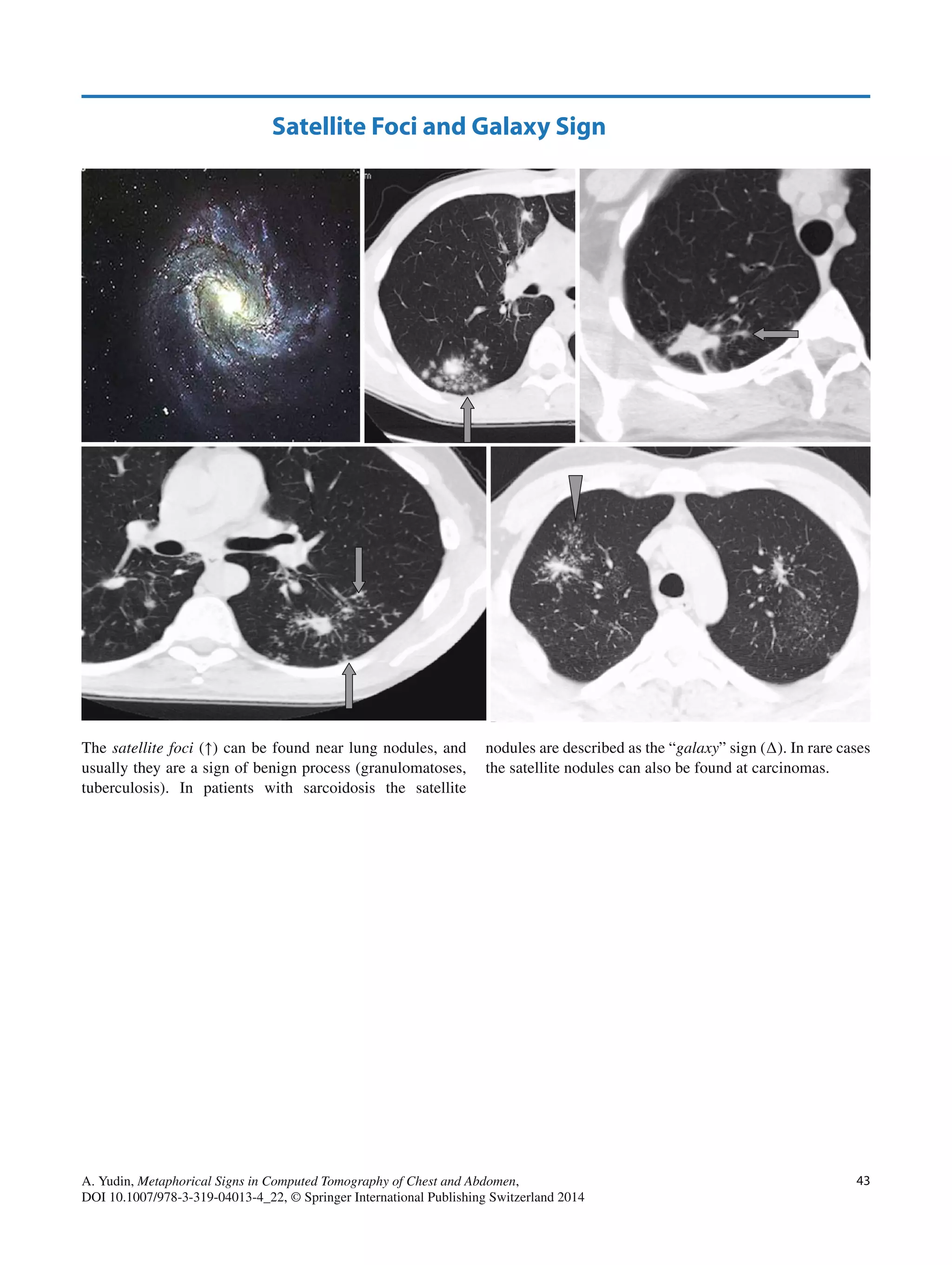 0. metaphorical signs in computed tomography of chest and abdomen | PDF