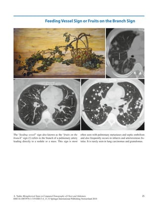 0. metaphorical signs in computed tomography of chest and abdomen | PDF