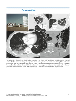 0. metaphorical signs in computed tomography of chest and abdomen | PDF