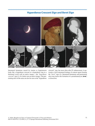 0. metaphorical signs in computed tomography of chest and abdomen | PDF
