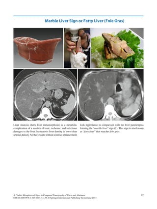0. metaphorical signs in computed tomography of chest and abdomen | PDF