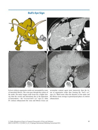 0. metaphorical signs in computed tomography of chest and abdomen | PDF