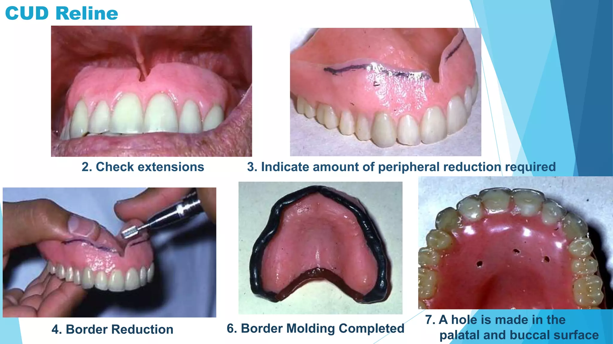 13- Relining, rebasing and repair of removable dentures.pptx