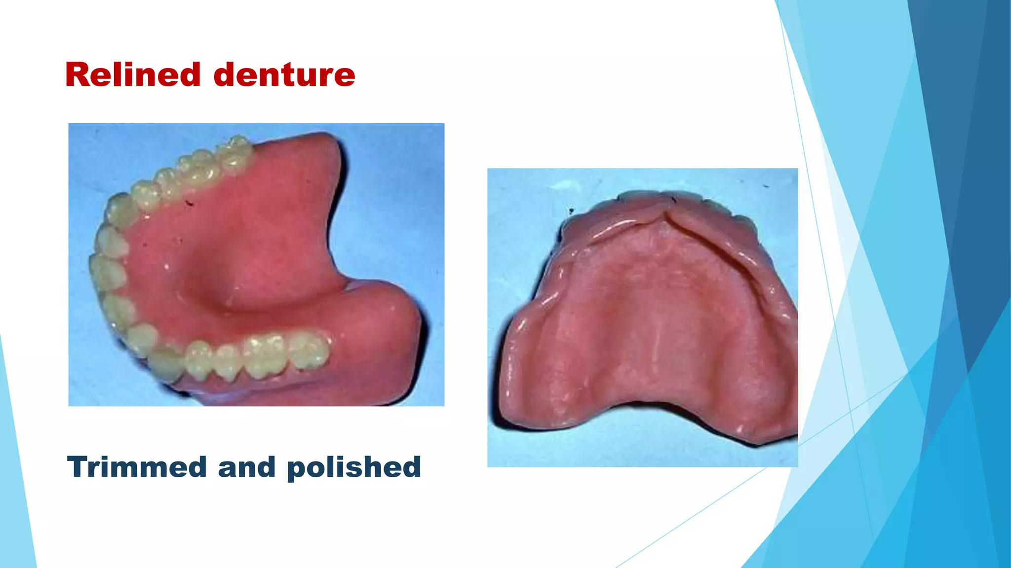 13- Relining, rebasing and repair of removable dentures.pptx