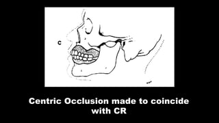 01- Occlusion in prosthodontics introduction -5th year | PPTX