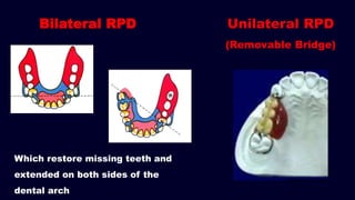 Other forms of removable partial denture | PPTX