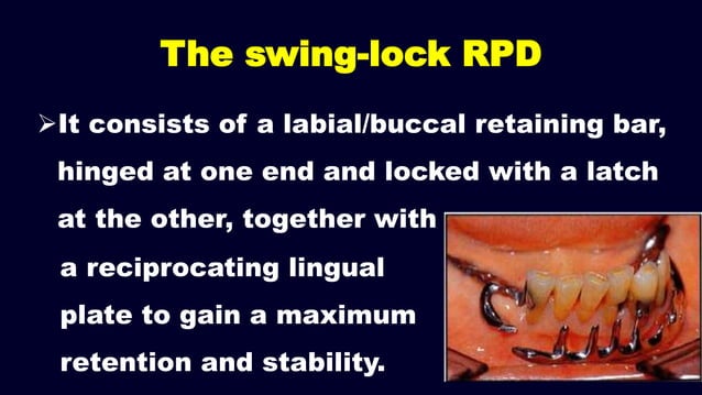 Other forms of removable partial denture | PPTX | Oral care | Personal Care