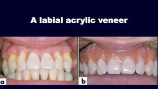 Other forms of removable partial denture | PPTX