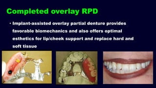 Other forms of removable partial denture | PPTX
