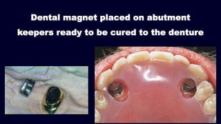 Other forms of removable partial denture | PPTX