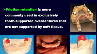 Other forms of removable partial denture | PPTX