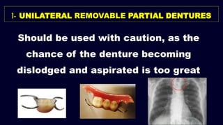 Unilateral Removable Partial Denture