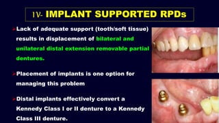 Unilateral Removable Partial Denture