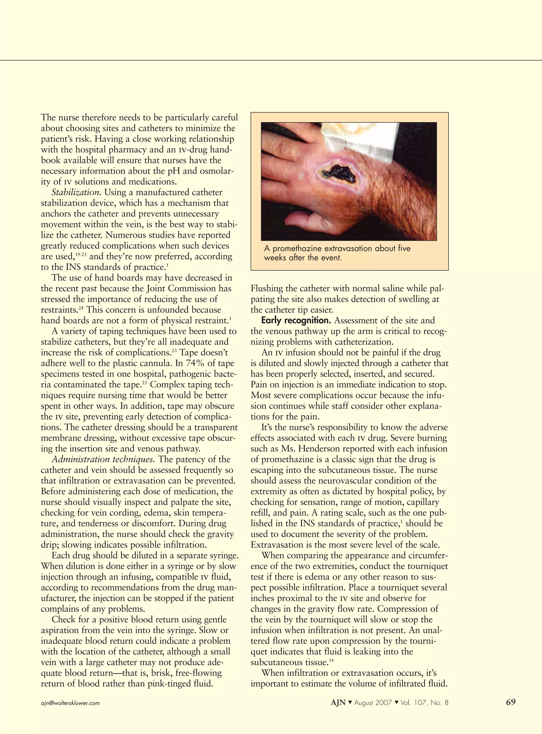 Infiltration and Extravasation-Preventing a complication of IV ...