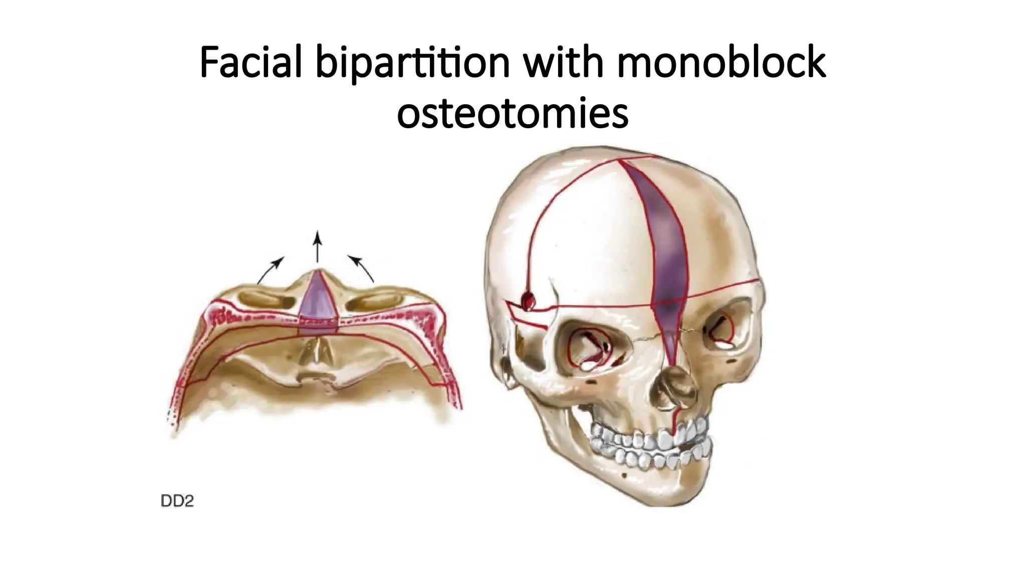 00003 CRANIOSYNOSTOSIS.pptx. SHARED THE KNOWLEDGE | PPTX