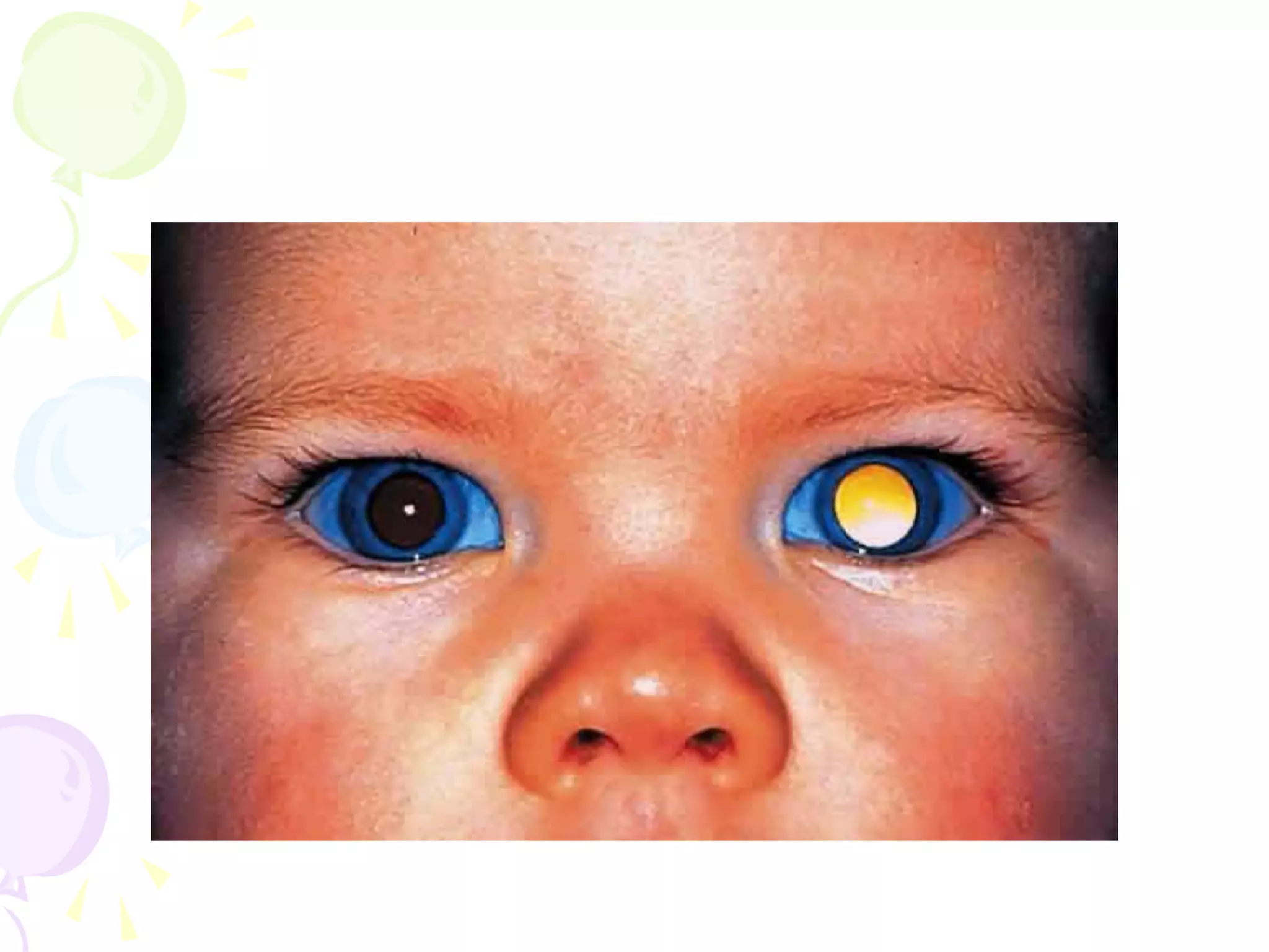 0001 leukocoria.ppt