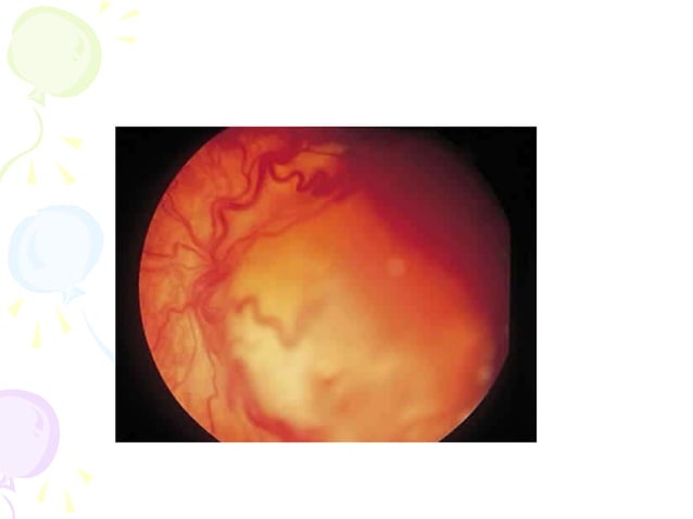 0001 leukocoria.ppt | Eye and Vision Conditions | Diseases and Conditions