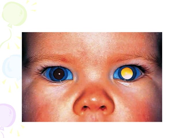 0001 leukocoria.ppt | Eye and Vision Conditions | Diseases and Conditions