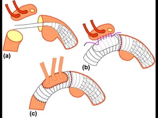 Elephant Trunk after Borst | PPT