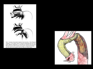 Elephant Trunk after Borst | PPT
