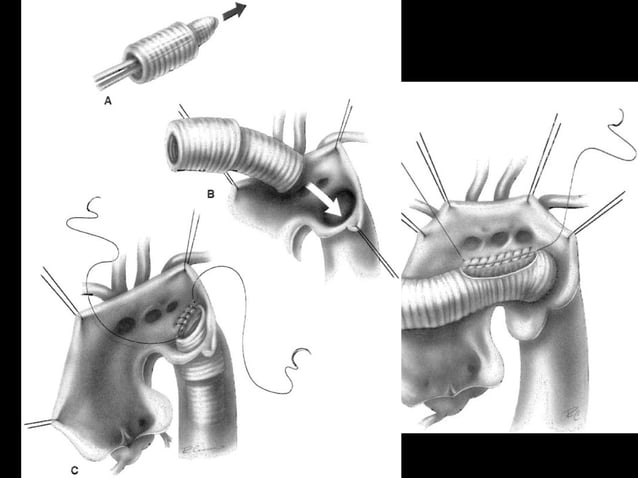 Elephant Trunk after Borst | PPT