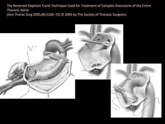 Elephant Trunk after Borst | PPT | Heart and Cardiovascular Diseases ...