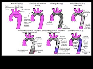 Elephant Trunk Procedure Stages