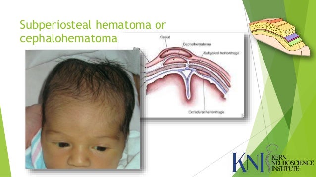Subperiosteal Hematoma