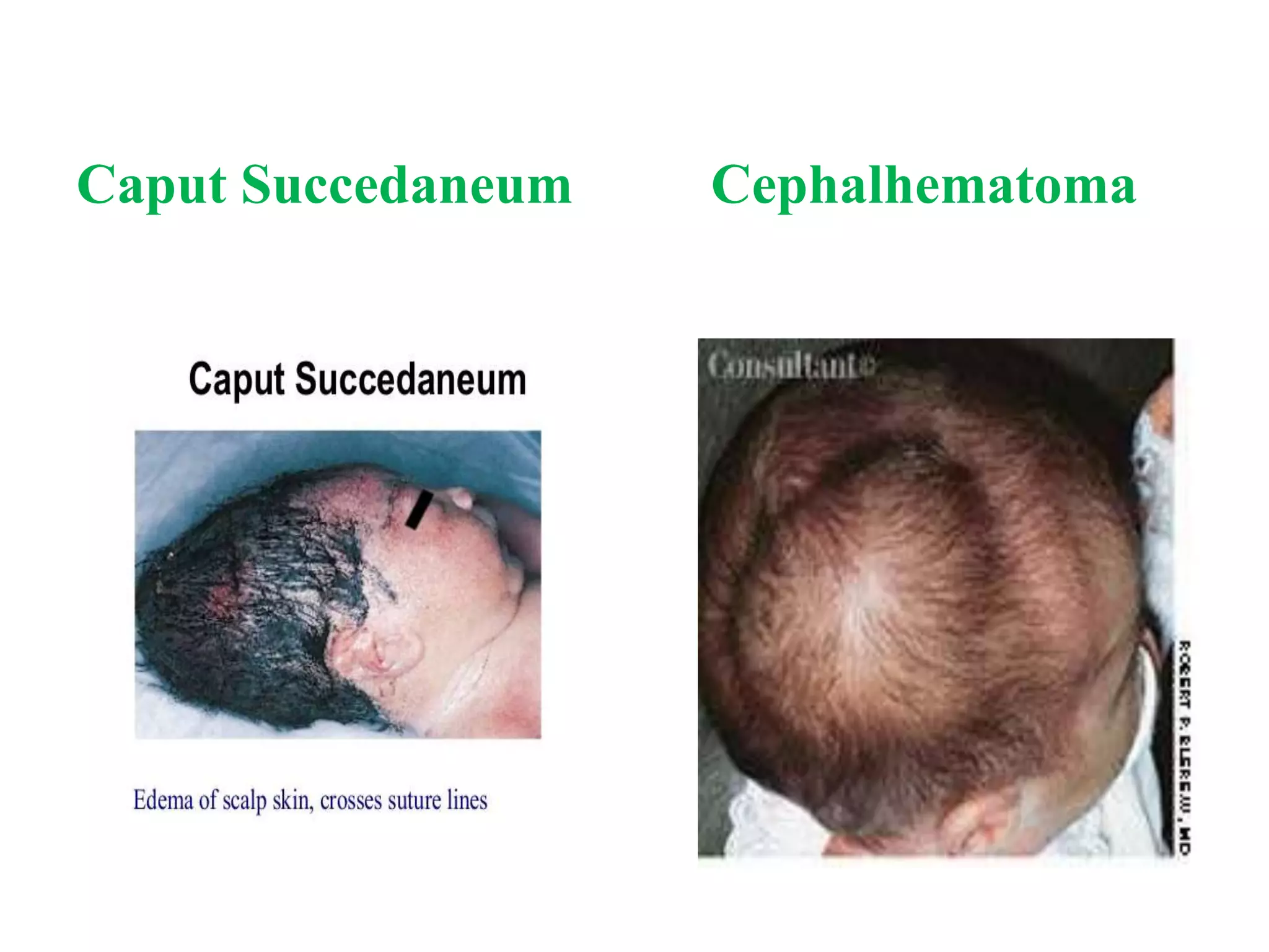 seminar on anemia in newborn | PPT