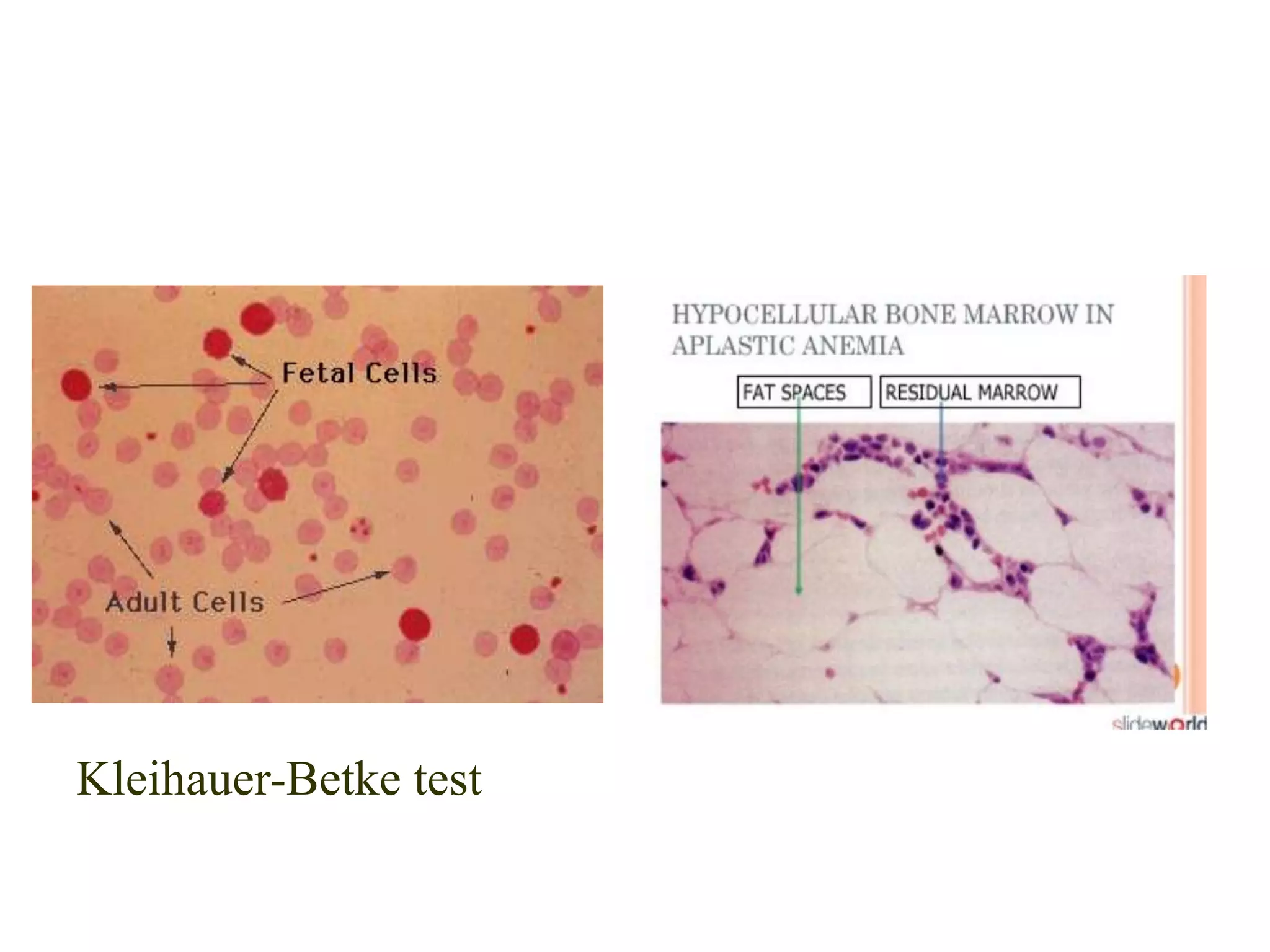 seminar on anemia in newborn | PPT