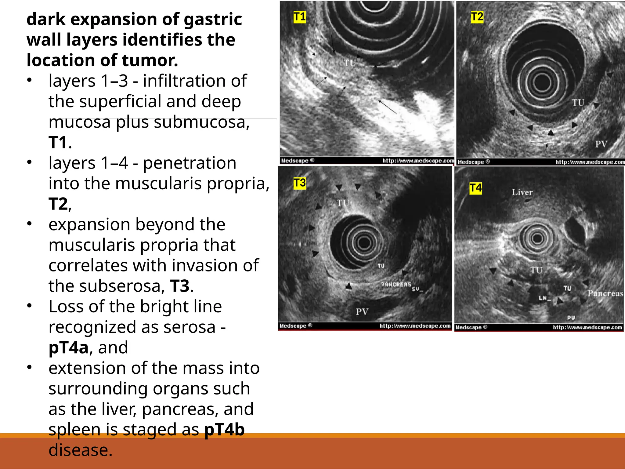 Gastric Cancer Investigations and management | PPTX