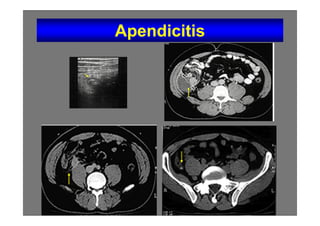 002 apendicitis aguda | PDF