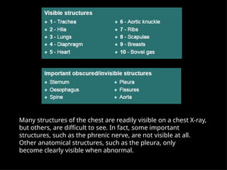 Chest Radiographic Anatomy for radiology rotation | PPTX