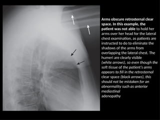 Chest Radiographic Anatomy for radiology rotation | PPTX