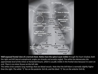 Chest Radiographic Anatomy for radiology rotation | PPTX