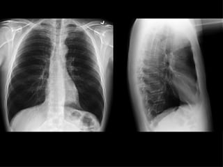 Chest Radiographic Anatomy for radiology rotation | PPTX