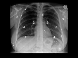 Chest Radiographic Anatomy for radiology rotation | PPTX