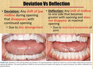 Temporomandibular Dysfunctions – Part 2 History, Clinical Examination ...