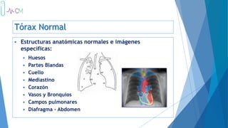 002 torax normal dx imagenes era 1 | PDF