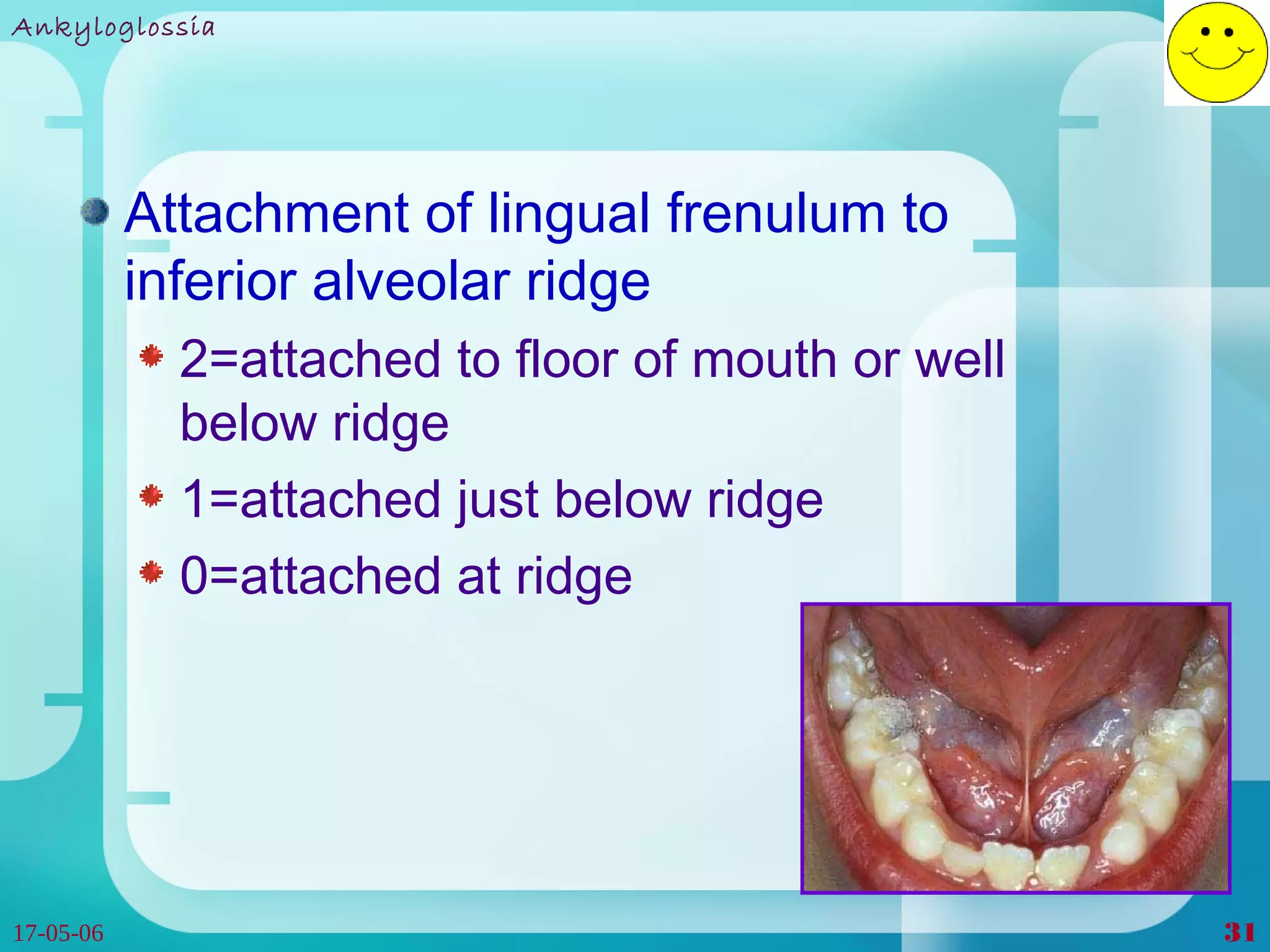 Ankyloglossia a congenital oral anomaly | PPT