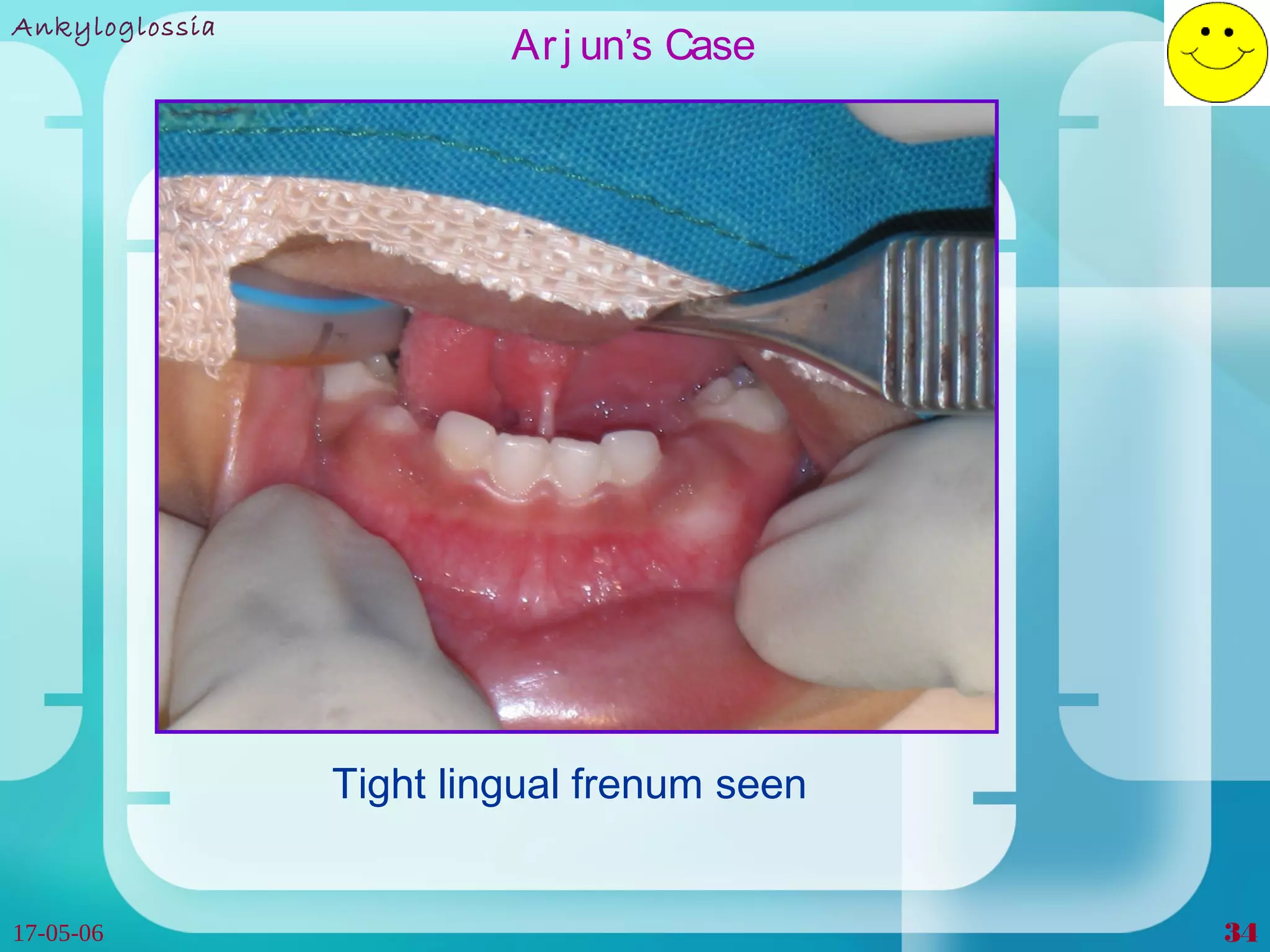 Ankyloglossia a congenital oral anomaly | PPT