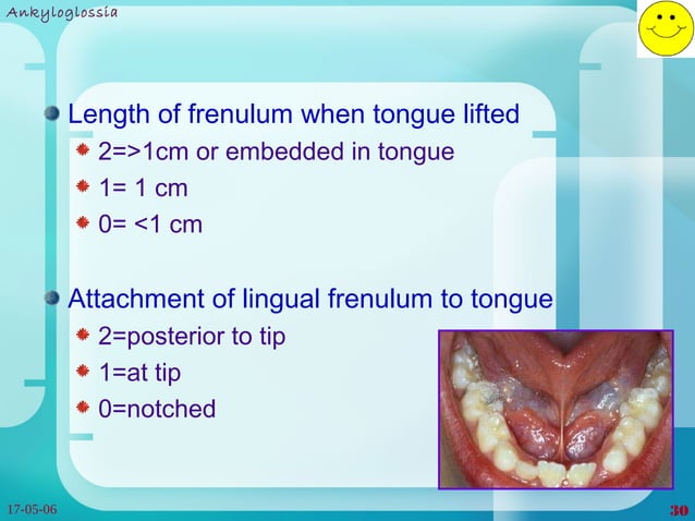 Ankyloglossia a congenital oral anomaly | PPT
