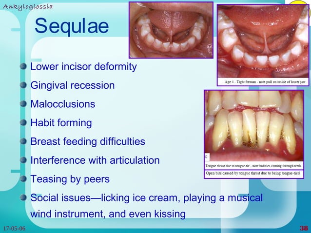 Ankyloglossia a congenital oral anomaly | PPT