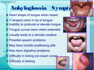 Ankyloglossia a congenital oral anomaly | PPT