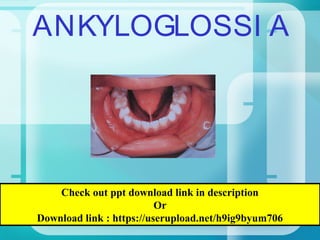 Ankyloglossia
