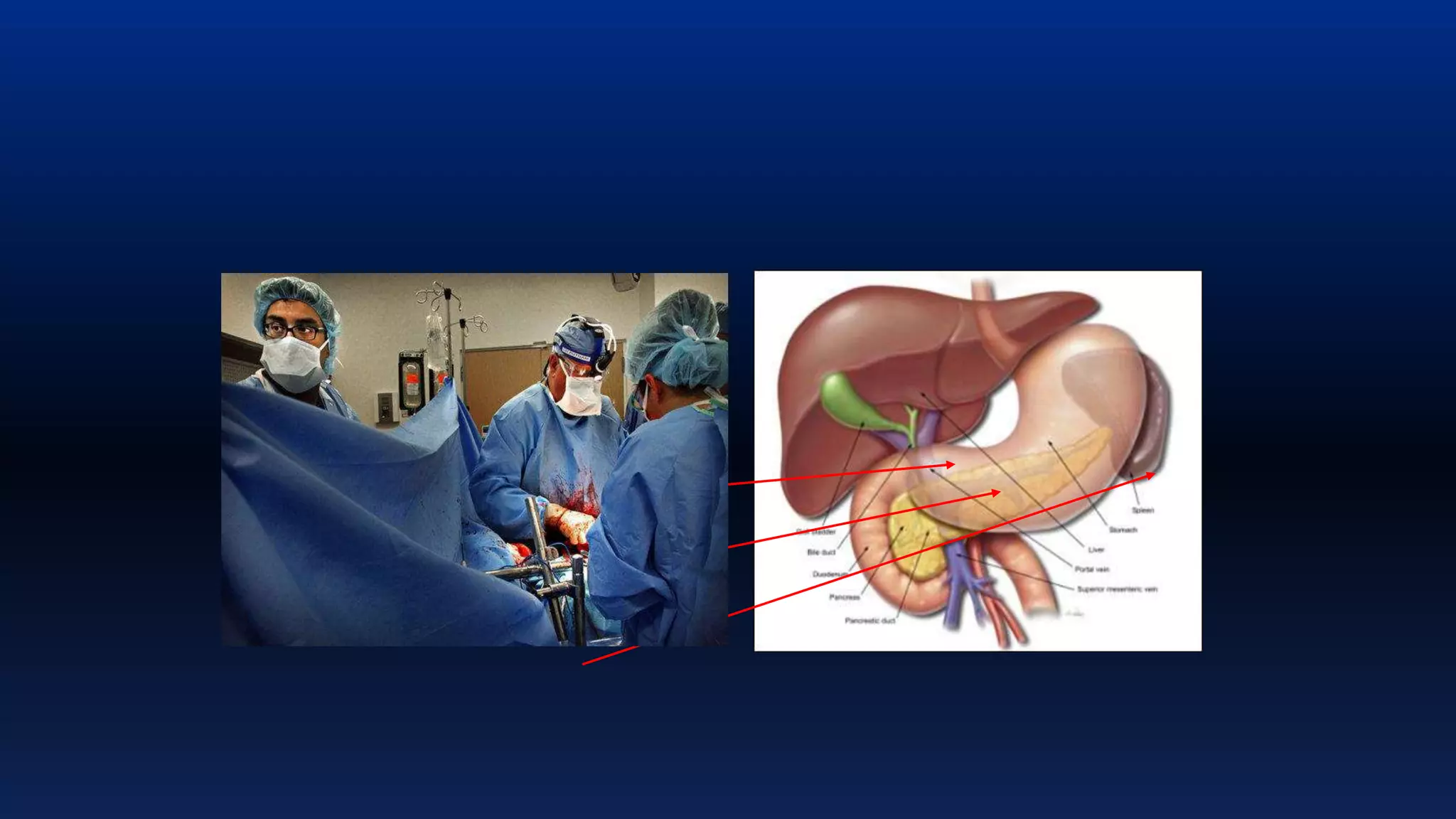 MGB Background MGB = Routine Surgery, MGB vs Sleeve Data, MGB Billroth ...