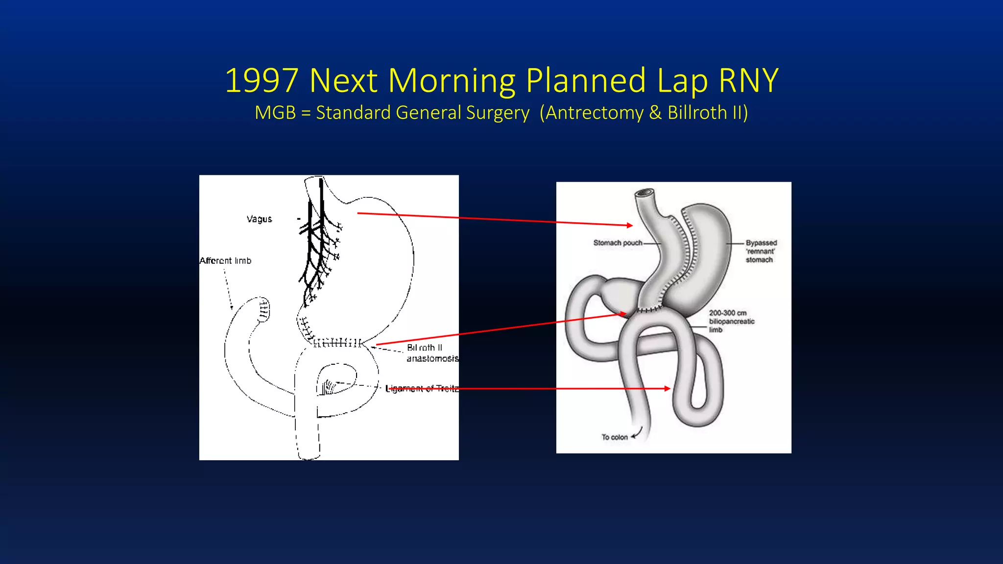 MGB Background MGB = Routine Surgery, MGB vs Sleeve Data, MGB Billroth ...